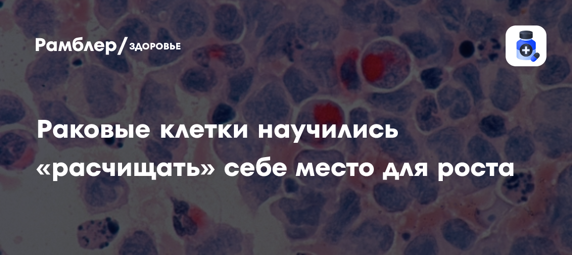 EMBO: раковые клетки используют соседние ткани как ресурс для роста ...